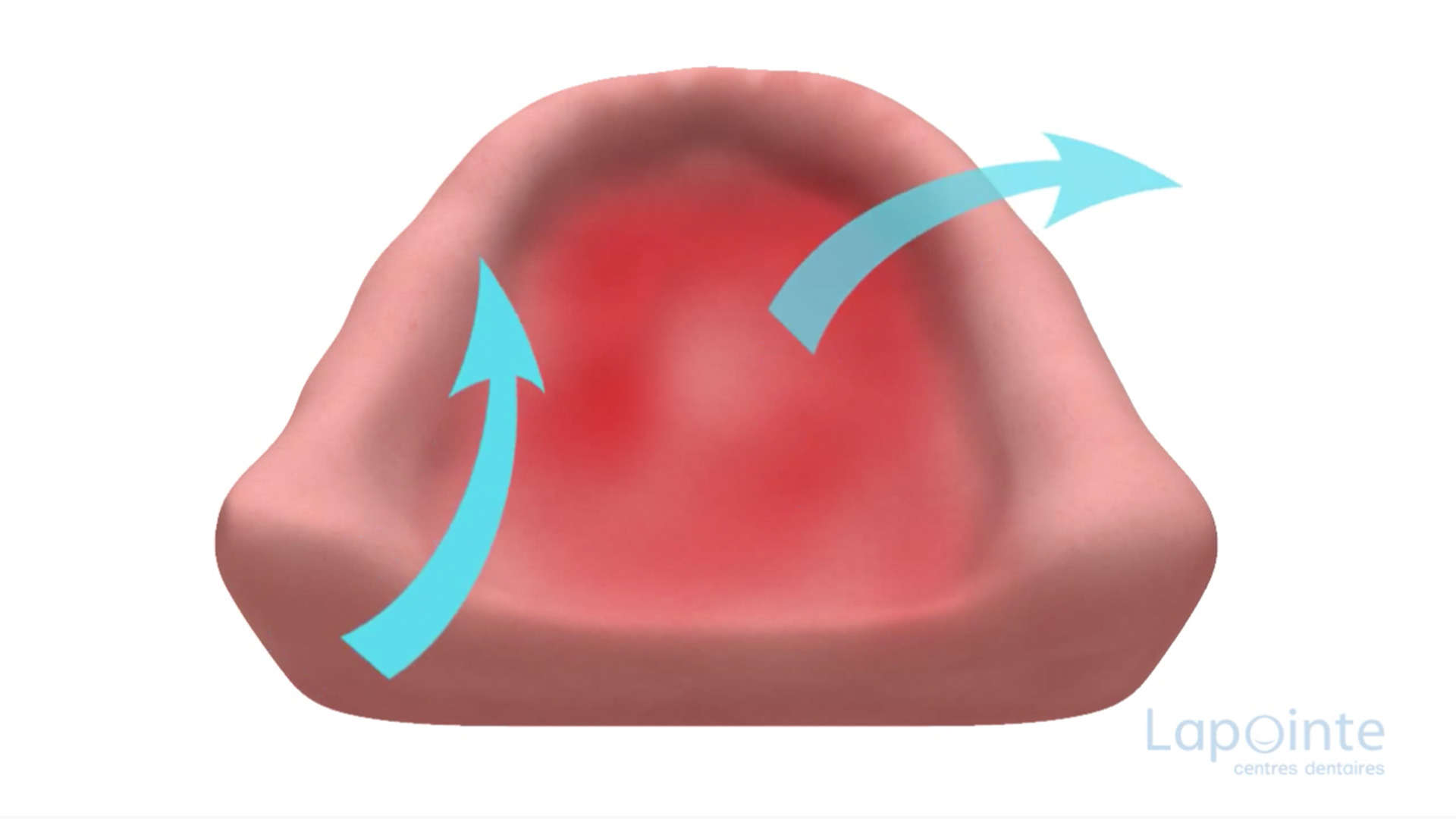 Removable dental prostheses | Lapointe Dental Centres