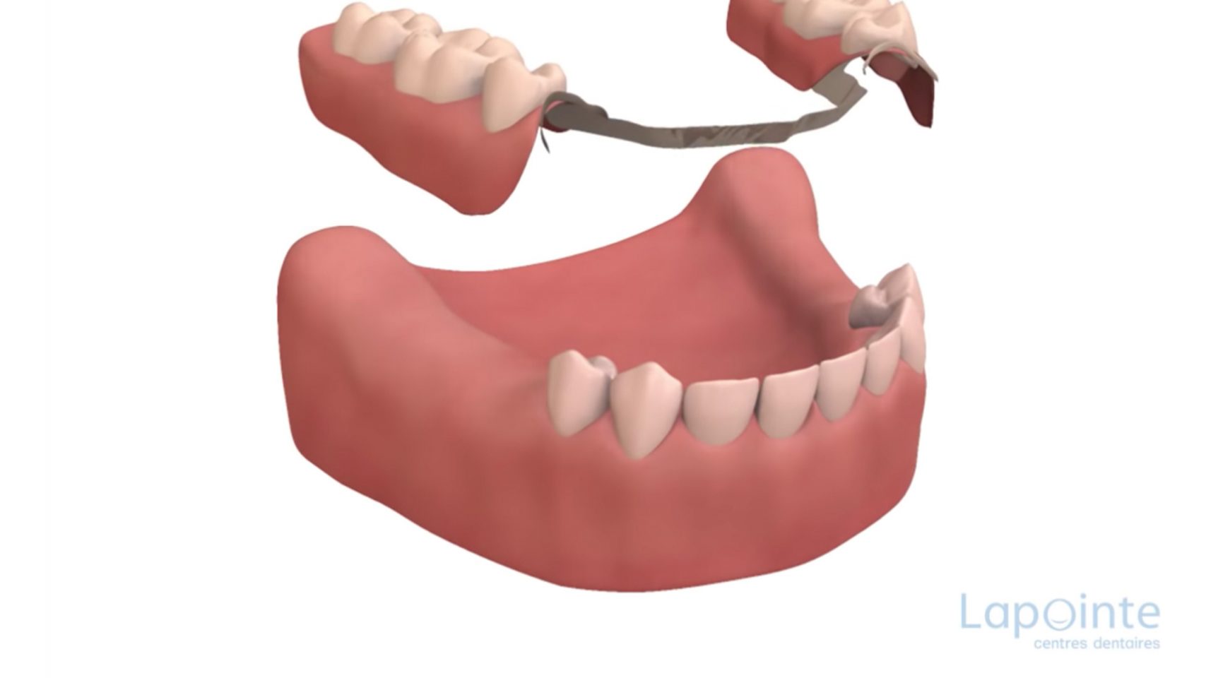 Prothèses dentaires amovibles, Complètes & Partielles | Centres ...