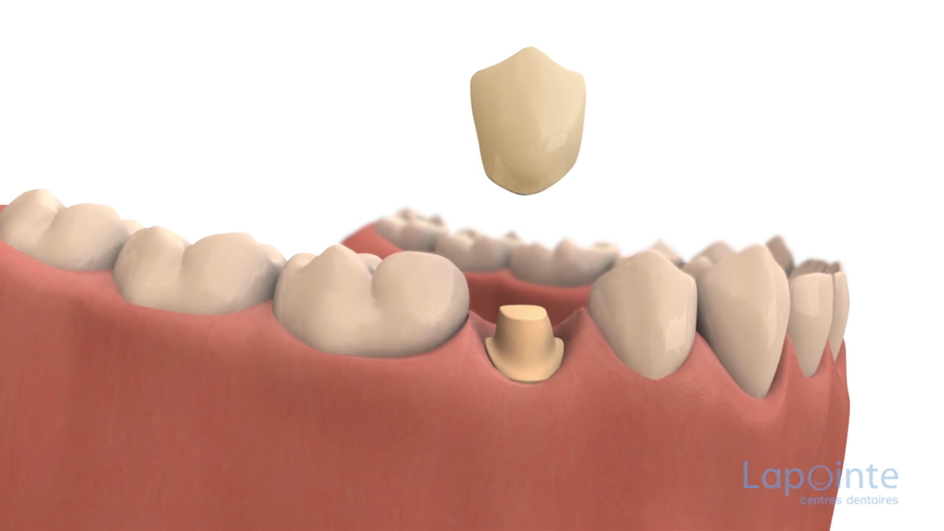 Couronne et pont | Centres dentaires Lapointe