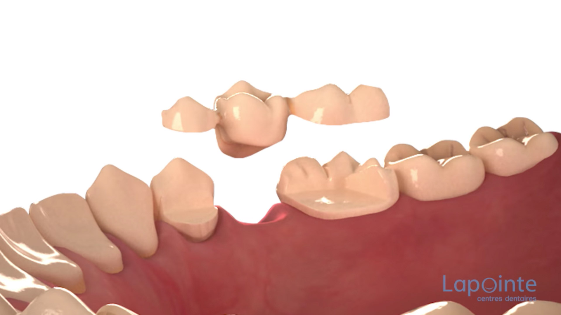 Remplacement de dents | Centres dentaires Lapointe