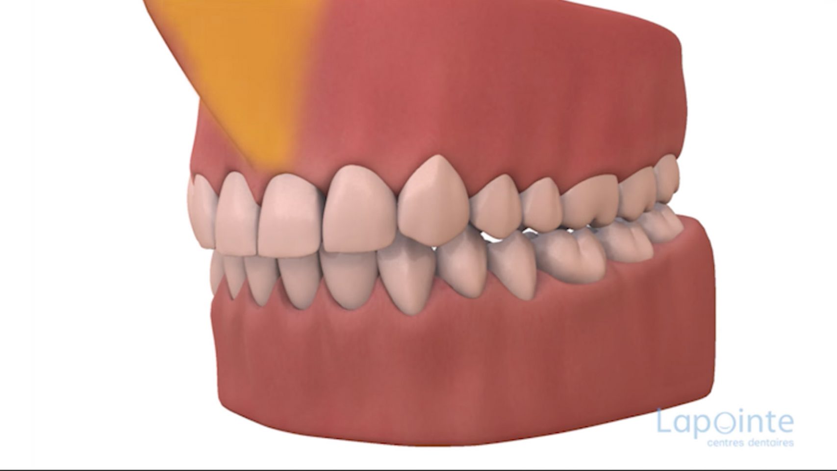 Frénectomie | Centres dentaires Lapointe