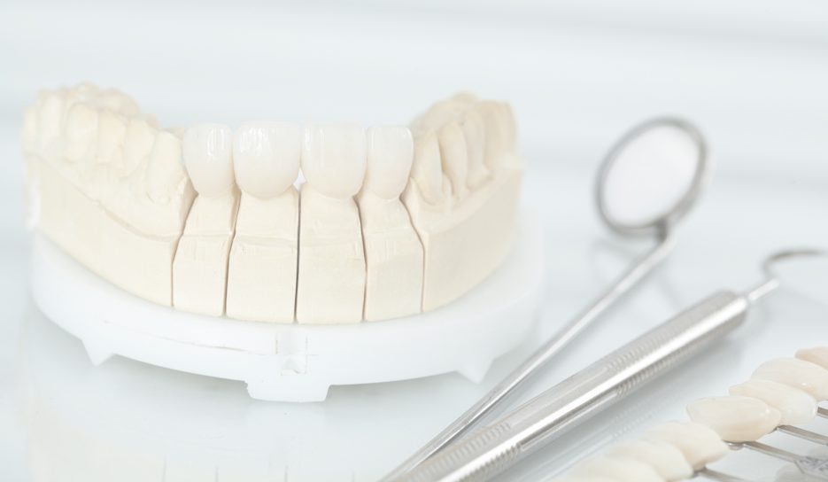 Les différents types de ponts | Centres dentaires Lapointe